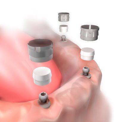 Locator-Prothese | Prothese ohne Gaumenplatte auf Implantaten | Locator ...